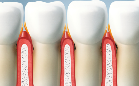 What Is Gum Overgrowth? - Dental Implants & Periodontal Health of Rochester